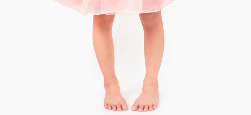 Comprehensive Guide to Understanding Bowlegs and Knock Knees