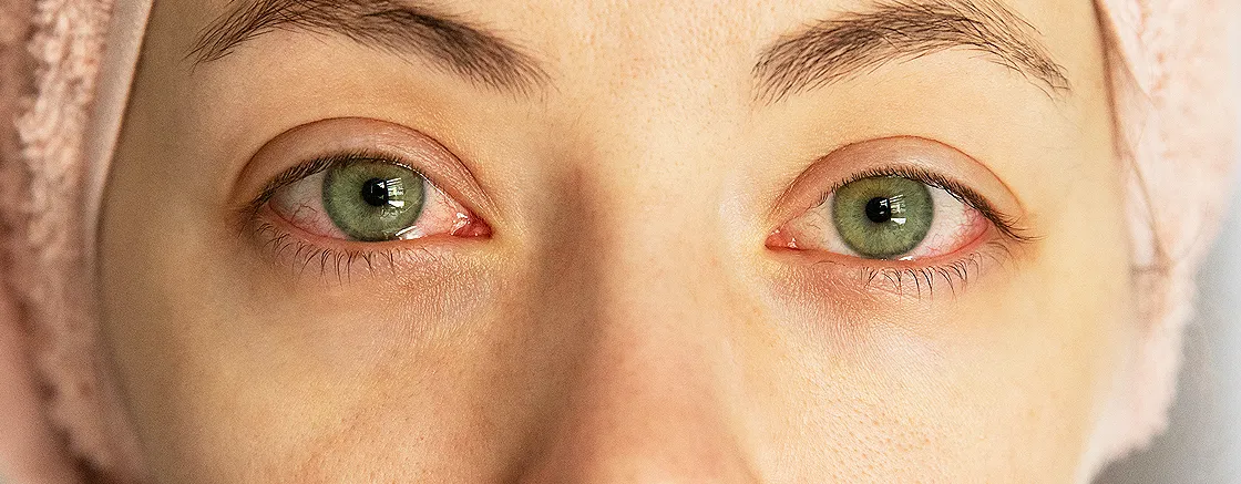 How Anemia Affects Your Skin: Signs Women Should Know